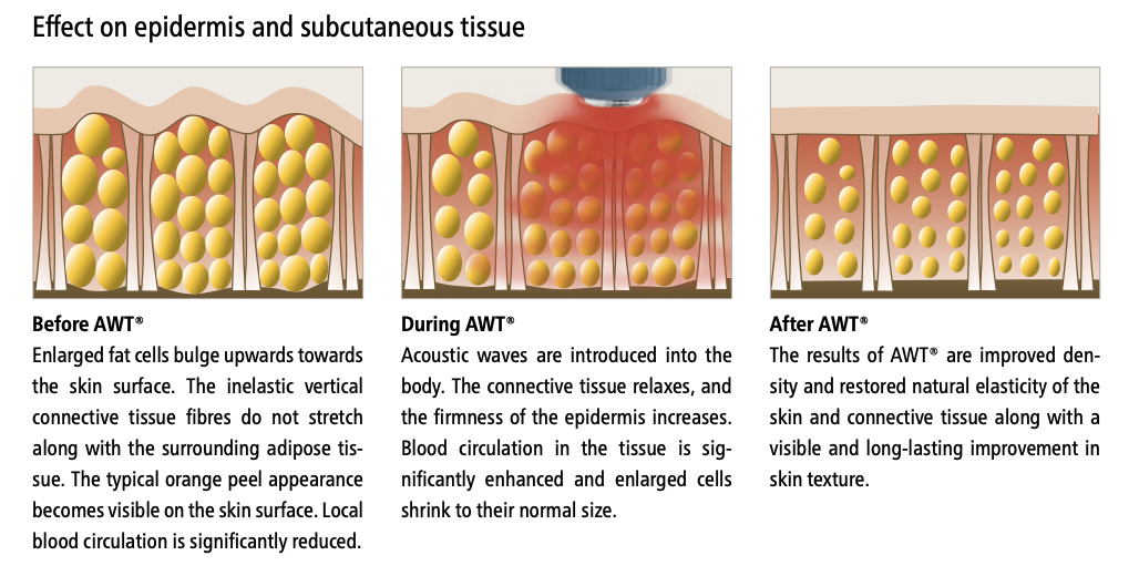 Cellulite Soundwave Solutions | Cellulite Treatment Clifton Park, NY
